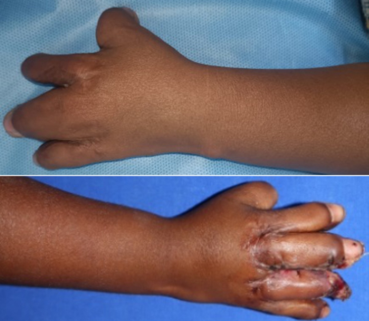 A girl's fused fingers are surgically separated